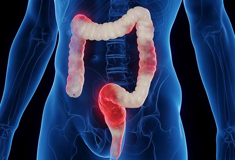 Estas son las principales causas del colon inflamado | Teletica