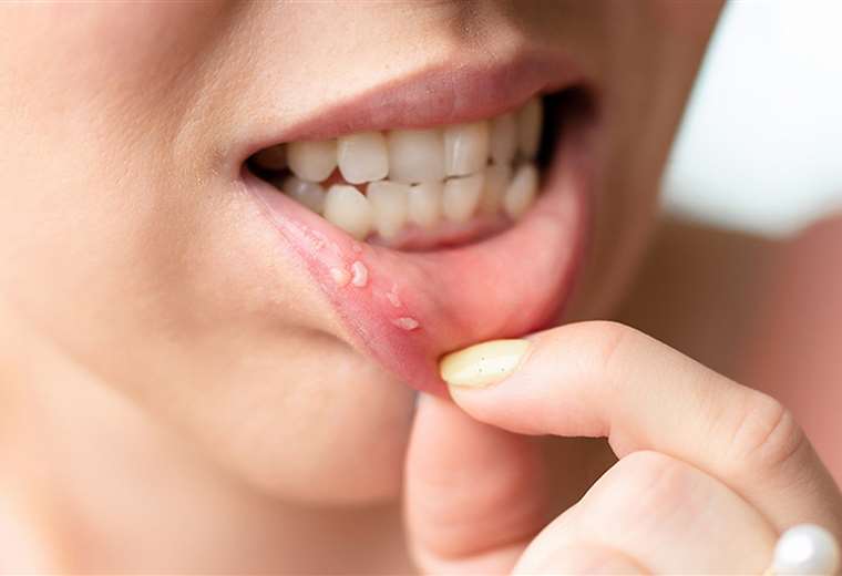 ¿Cómo lidiar con las molestas aftas bucales? | Teletica
