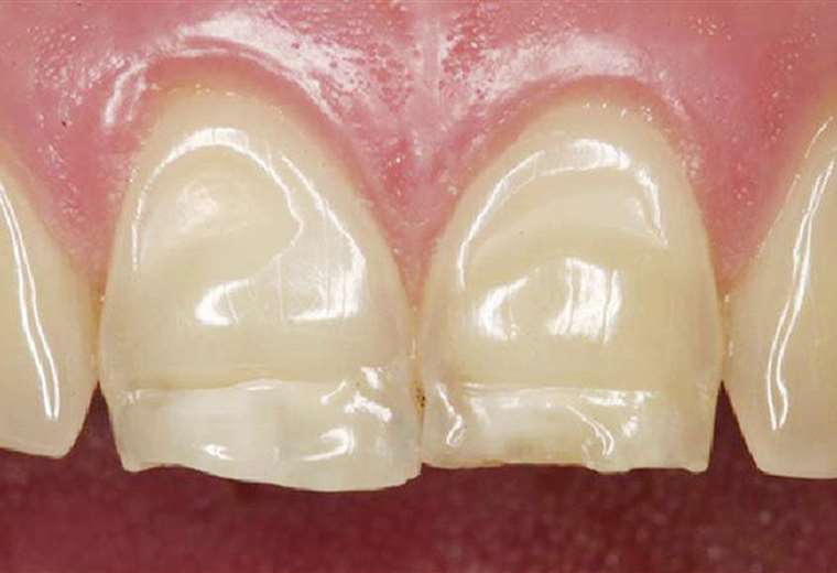 Erosión dental, ¿qué es y cómo tratarla? | Teletica