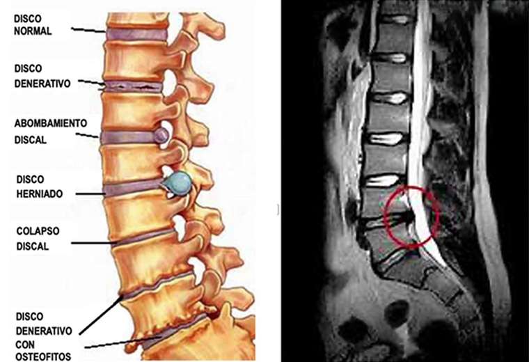 Encuentre alivio para el abombamiento discal | Teletica