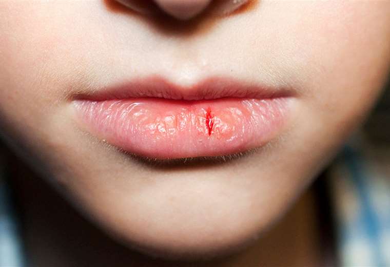 Si tiene labios resecos, esta información le interesa | Teletica