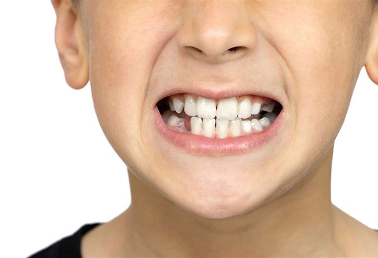 Aprenda a identificar las señales de bruxismo en niños | Teletica Aprenda a identificar las señales de bruxismo en niños | Teletica