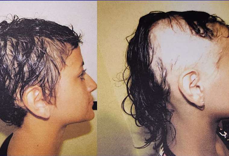 “El cabello no define tu personalidad”: La vida de Daniela con alopecia ...