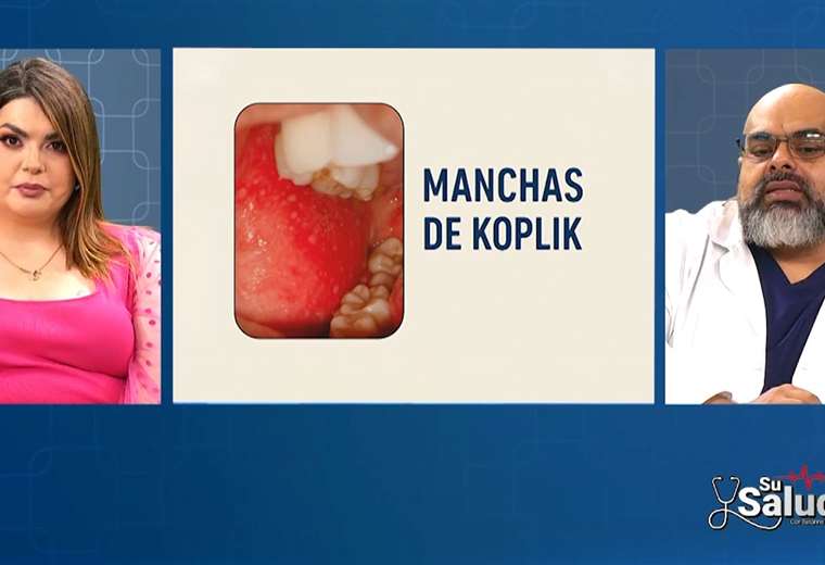 Manchas De Koplik